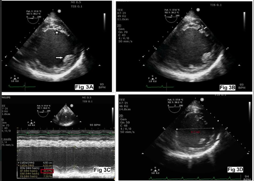Left Ventricular Non-Compaction Cardiomyopathy with Coronary Artery ...